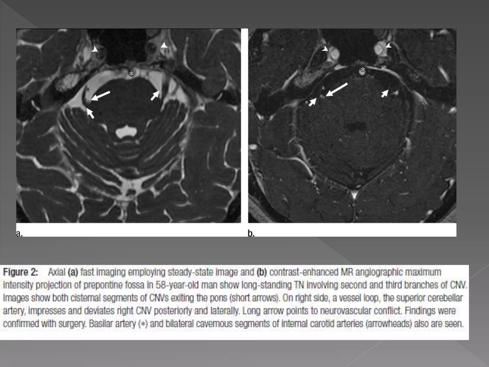 Imaging in Neurovascular conflicts [Neurovascular compression syndrome ...