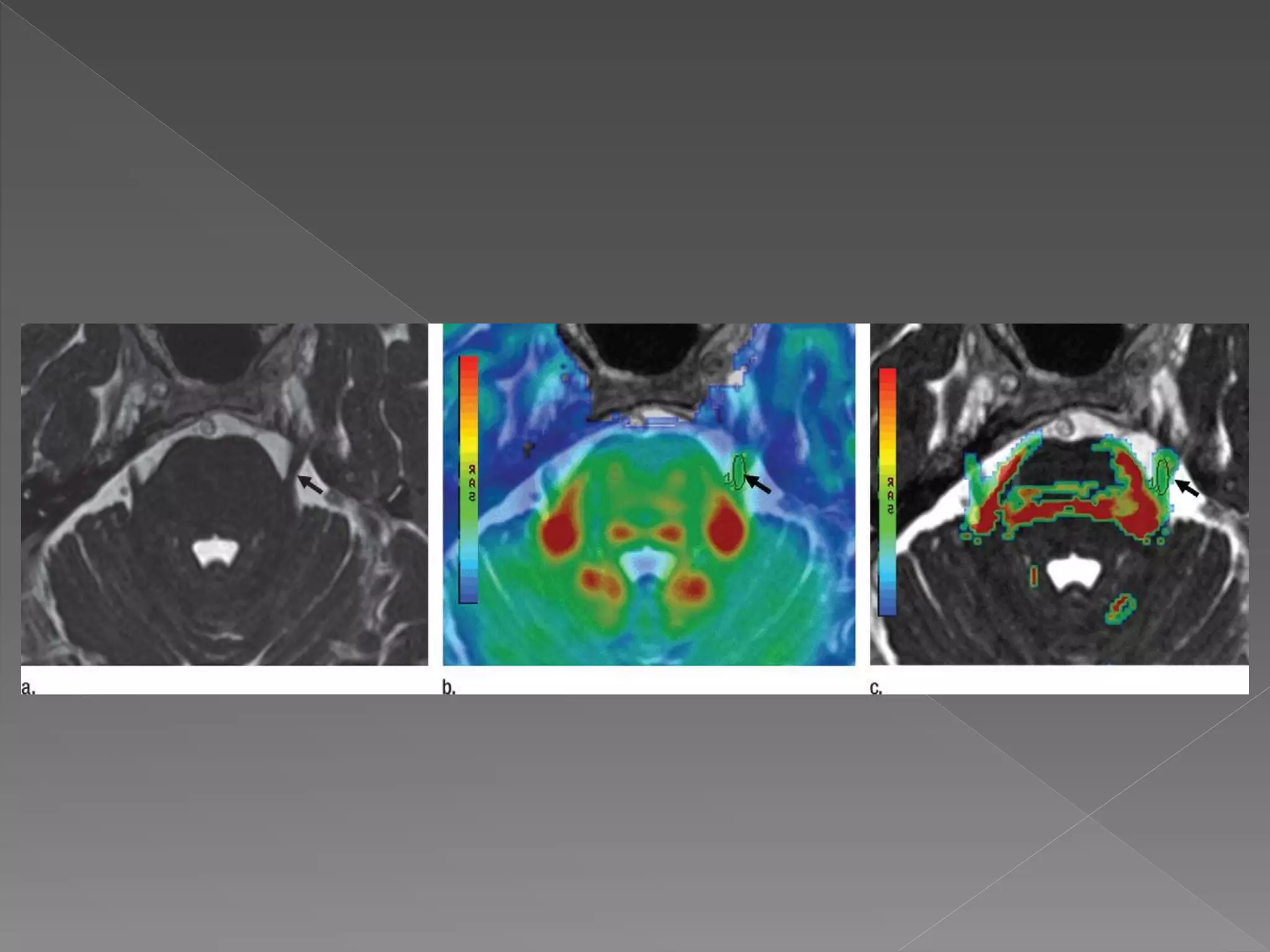 Imaging in Neurovascular conflicts [Neurovascular compression syndrome ...