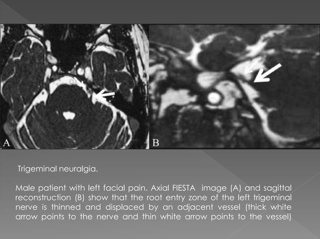 Imaging in Neurovascular conflicts [Neurovascular compression syndrome ...