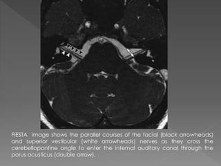 Imaging in Neurovascular conflicts [Neurovascular compression syndrome ...