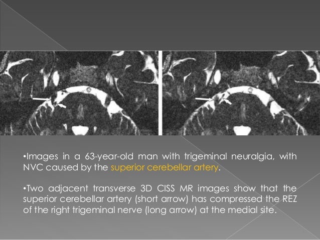 Imaging in Neurovascular conflicts [Neurovascular compression syndrom…
