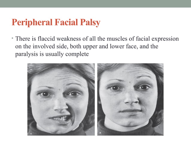 Cranial Nerve VII - Facial Nerve (Nervus facialis) | PPTX