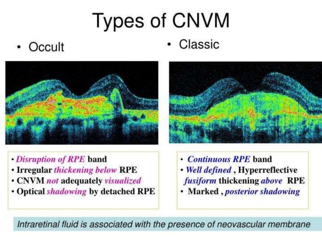 Choroidal neovascular membranes (CNVM) | PPTX