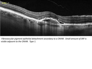 Choroidal Neovascular Membrane Oct