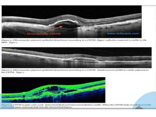 Choroidal Neovascular Membrane Oct