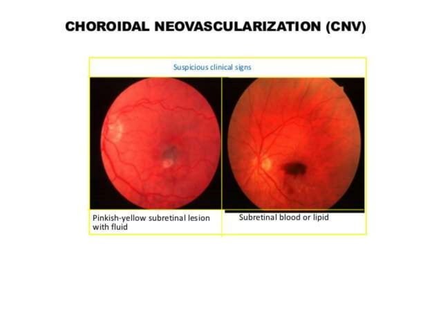 Choroidal neovascular membranes (CNVM)