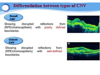 Choroidal neovascular membranes (CNVM) | PPT