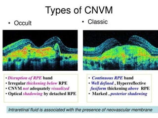 Choroidal neovascular membranes (CNVM) | PPT
