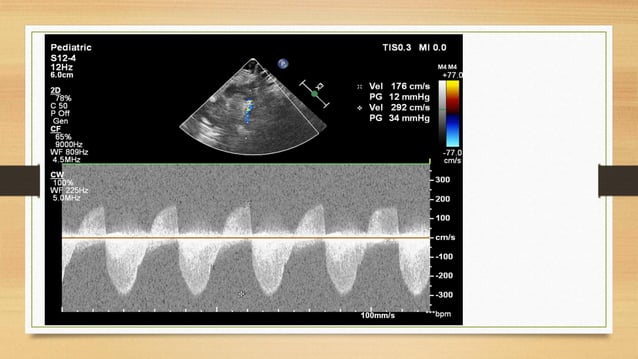 Co arctation of aorta may 2021 | PPT