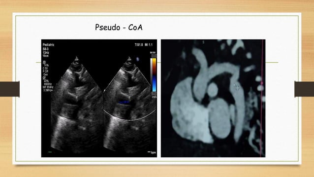 Co arctation of aorta may 2021 | PPT