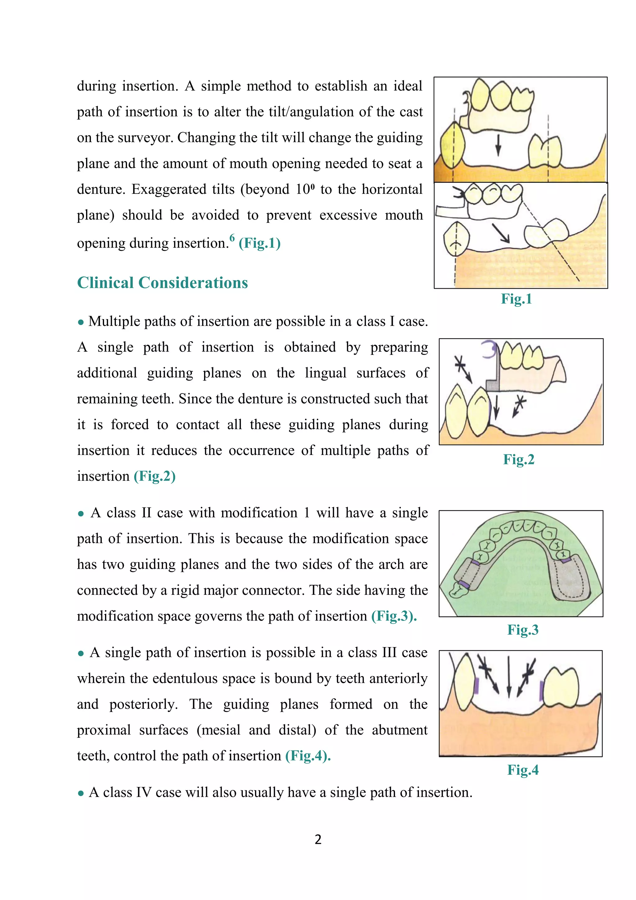 Co Cr RBD / the path of insertion, block out and relief | PDF