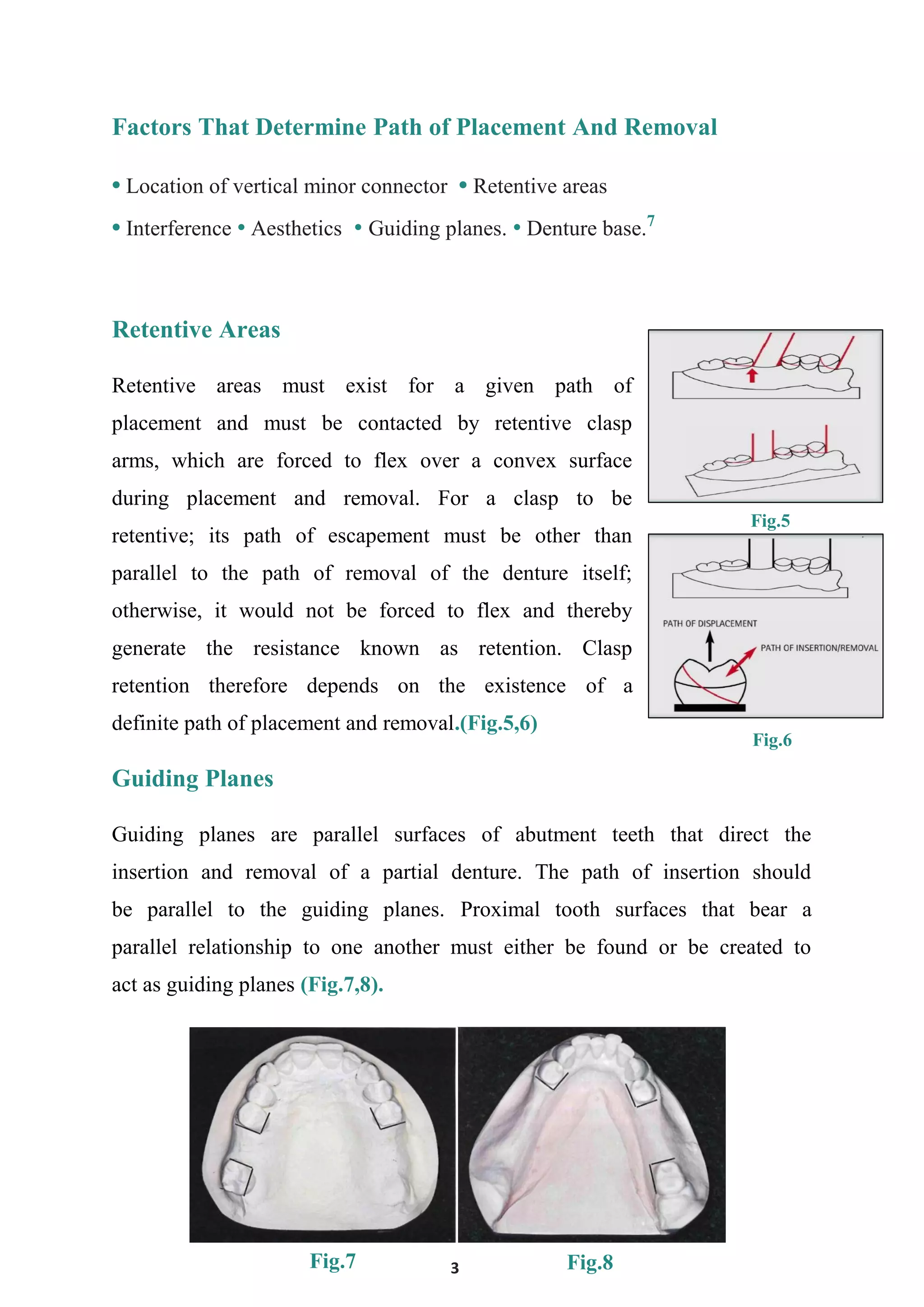 Co Cr RBD / the path of insertion, block out and relief | PDF