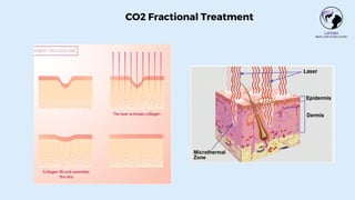 CO2 Fractional Treatment.pdf
