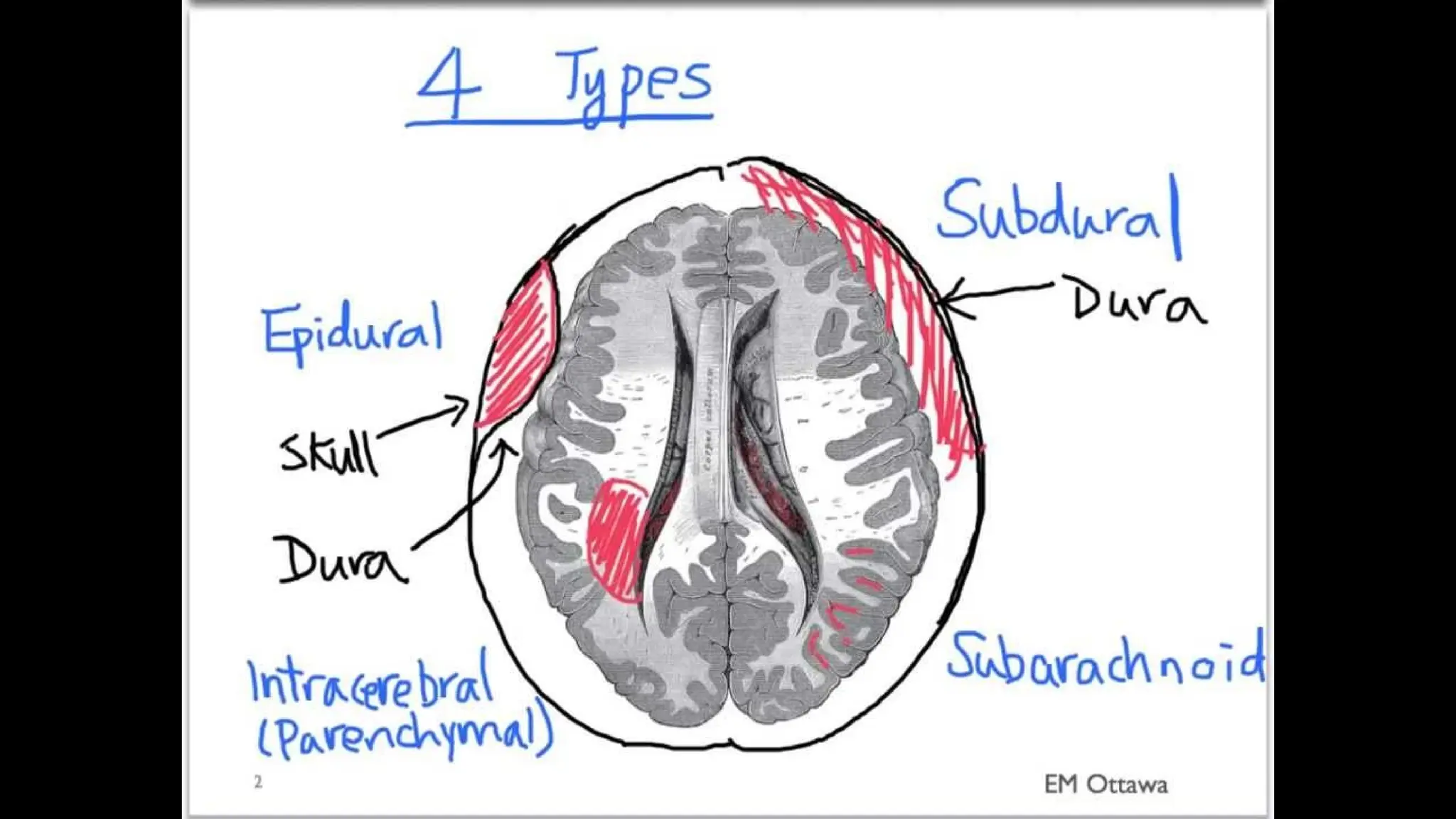 meninges, Dural sinuses and CSF circulation.pptx