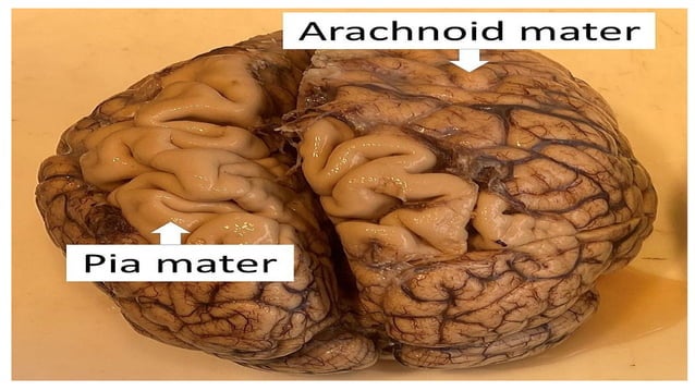 meninges, Dural sinuses and CSF circulation.pptx