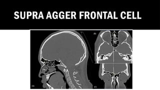 International Frontal Sinus Anatomy Classification | PPTX
