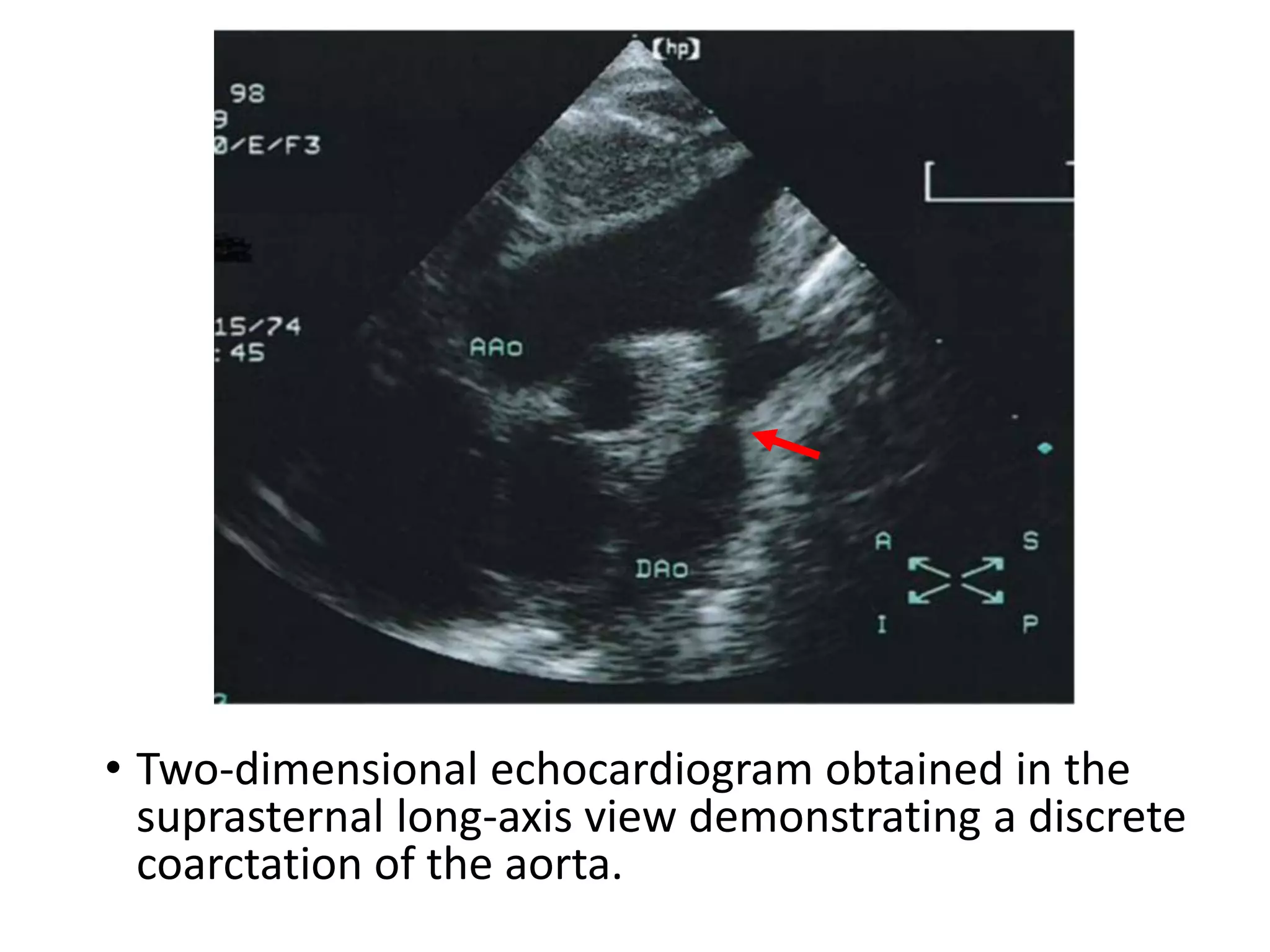 Coarctation of the Aorta | PPTX