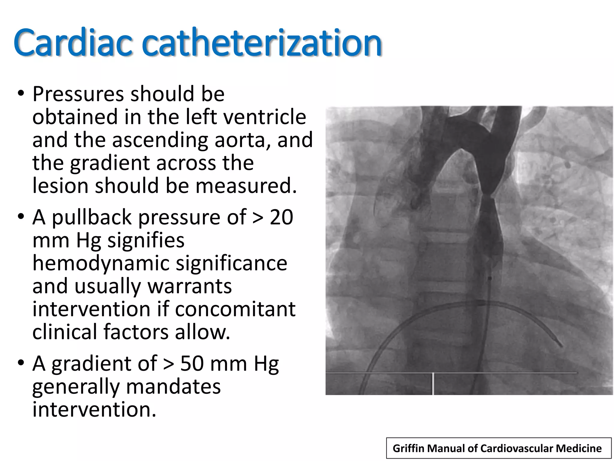 Coarctation of the Aorta | PPTX
