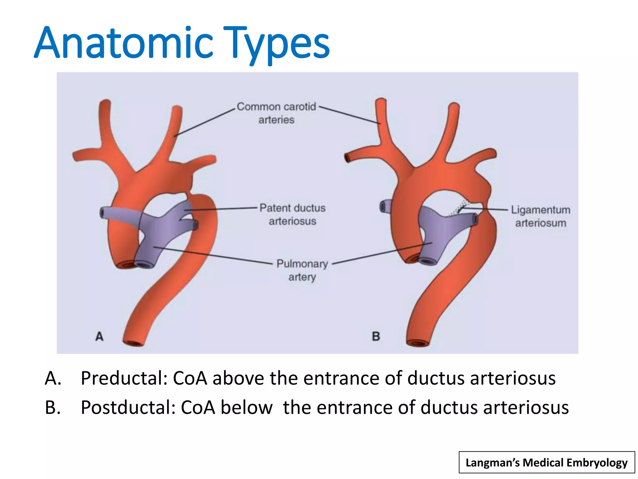 Coarctation of the Aorta | PPTX