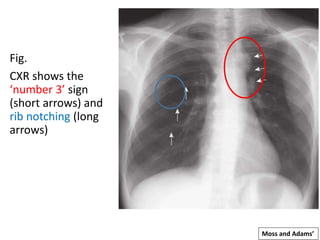Coarctation of the Aorta | PPTX