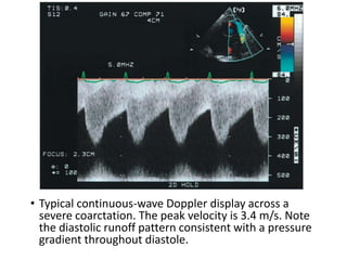Coarctation of the Aorta | PPT