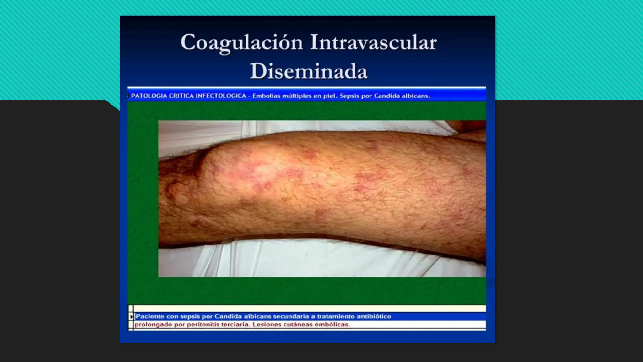 COAGULACIÓN INTRAVASCULAR DISEMINADA (CID) DIAPOSITIVAS (1).pptx