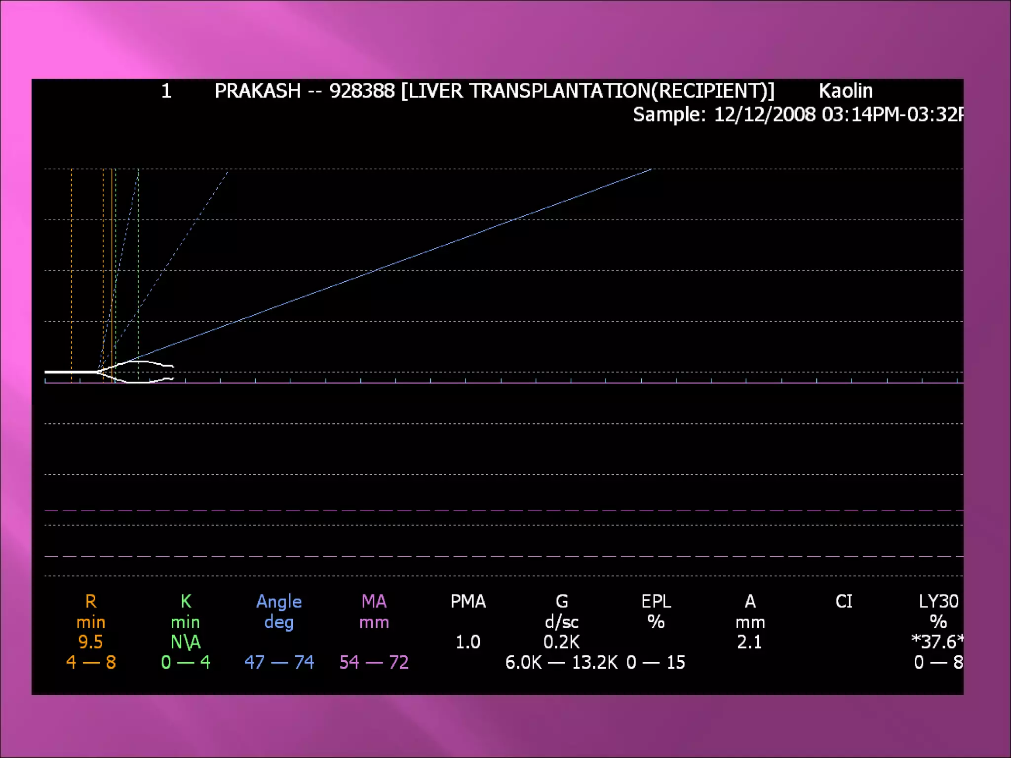 Coagulation and TEG | PPT