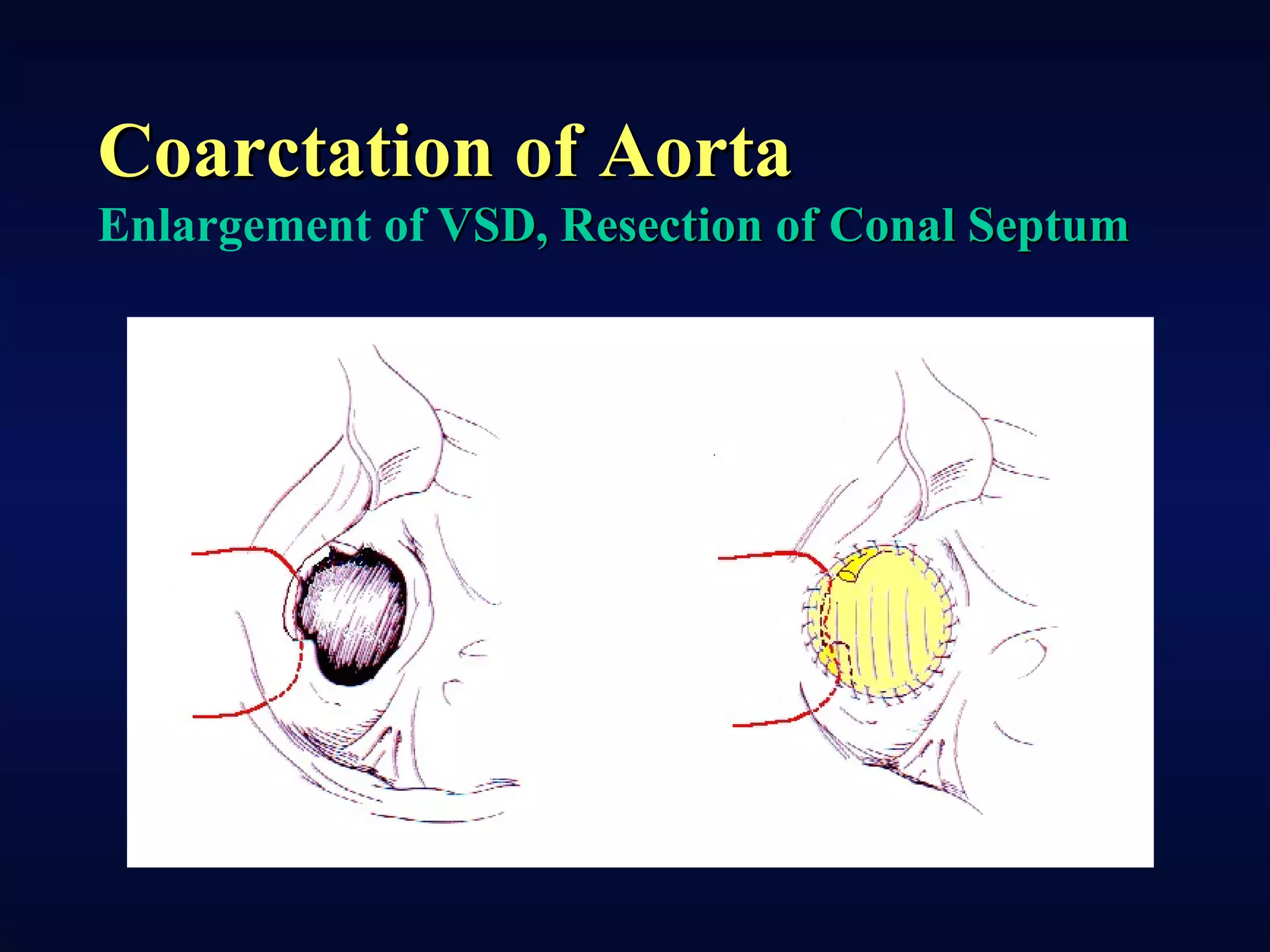 Coarctation Of Aorta | PPT