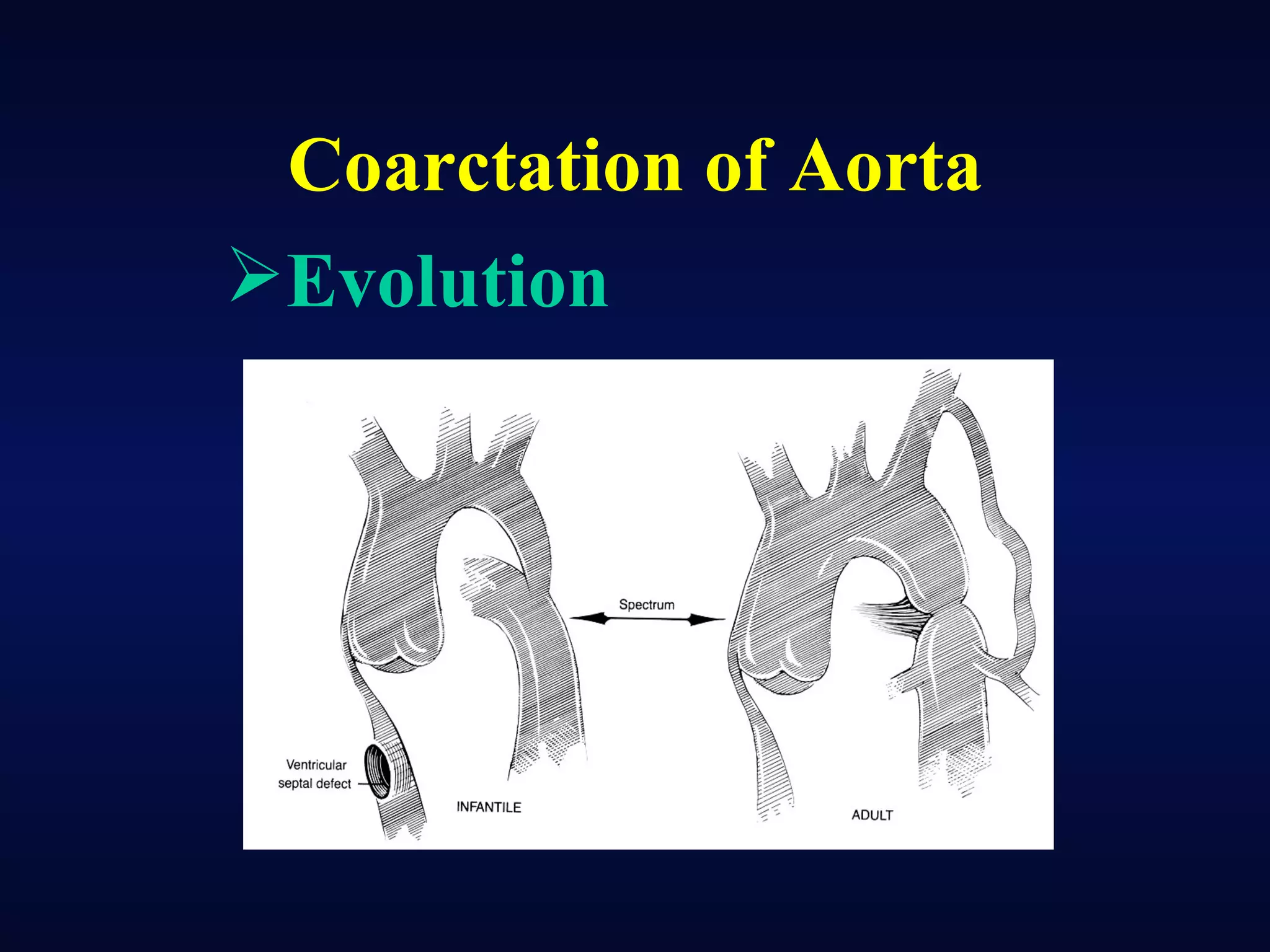 Coarctation Of Aorta | PPT