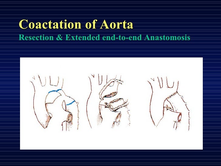 Coarctation Of Aorta