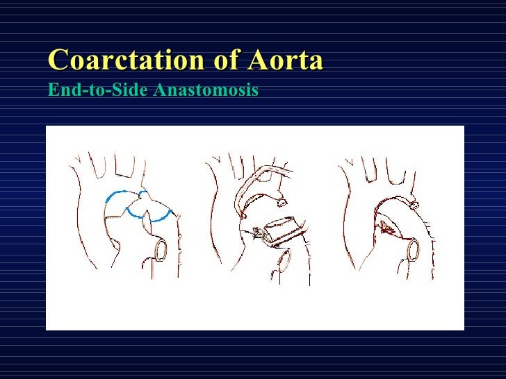 Coarctation Of Aorta