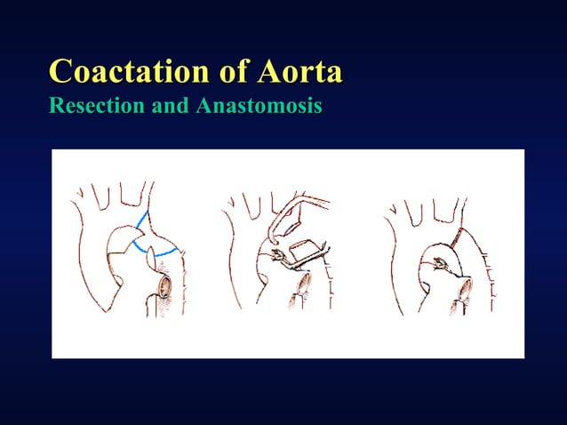 Coarctation Of Aorta | PPT