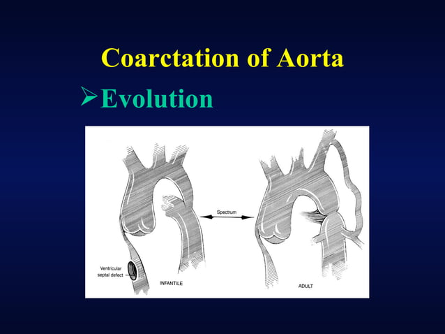 Coarctation Of Aorta Ppt