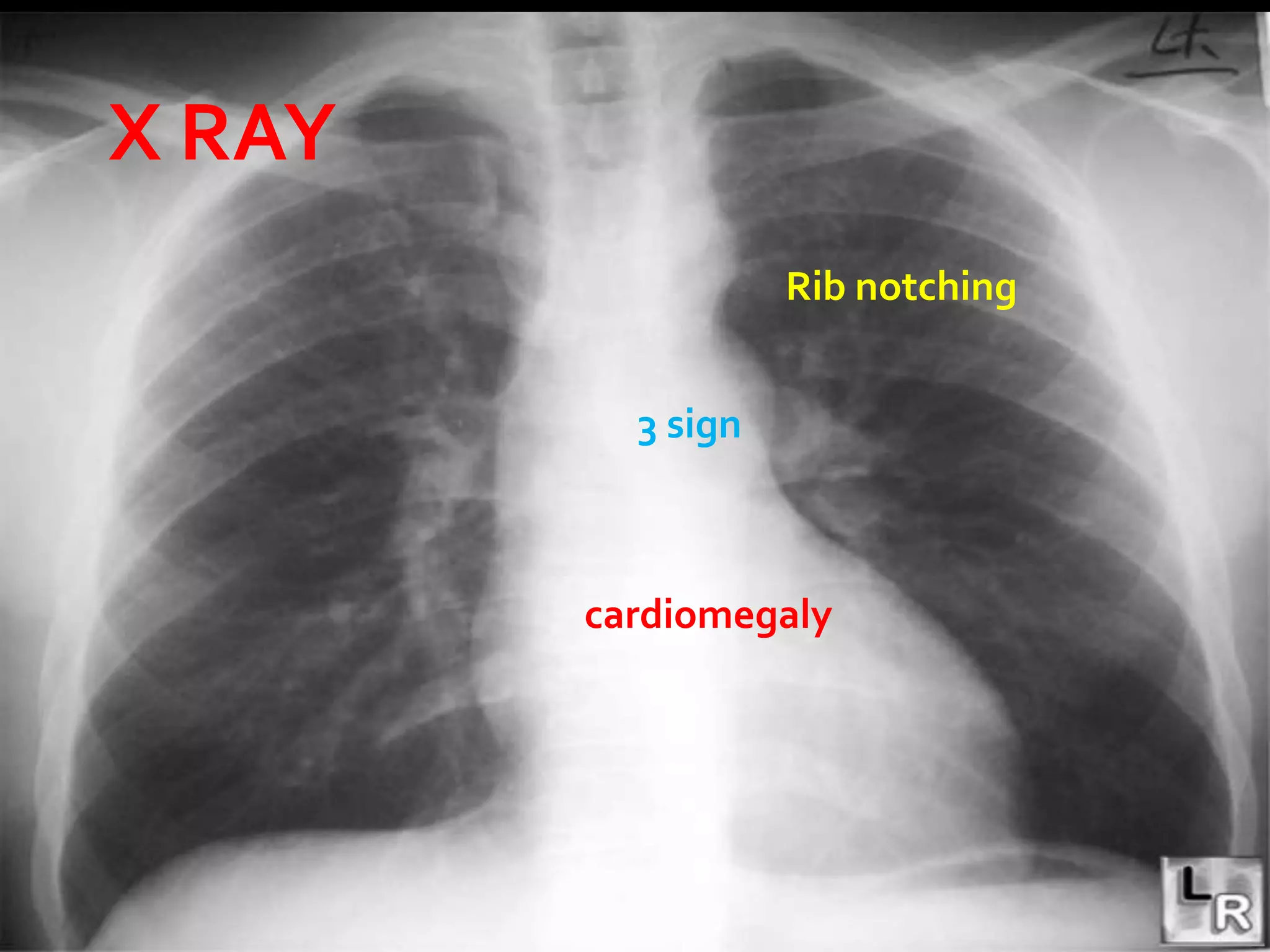 Coarctation of aorta | PPTX
