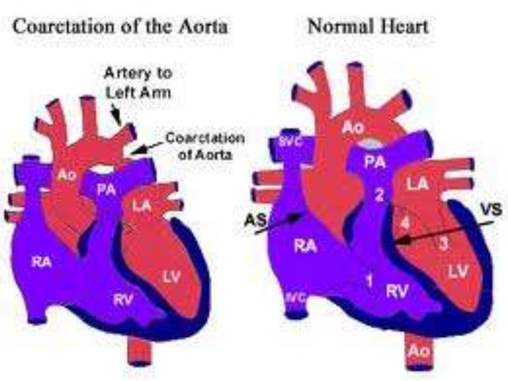 Coarctation Of Aorta