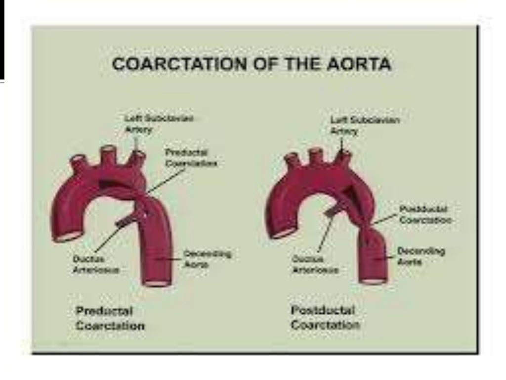 Coarctation Of Aorta