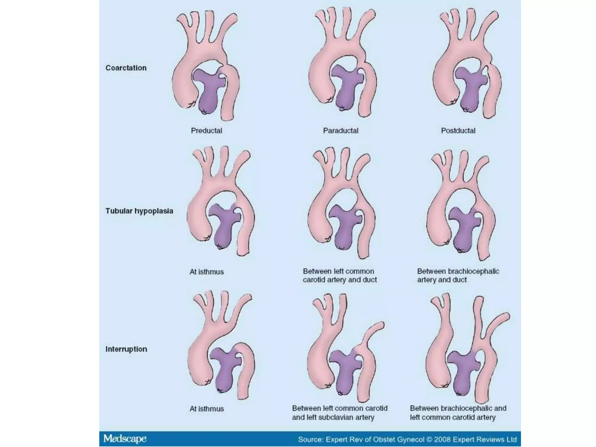 Coarctation of aorta | PPTX | Heart and Cardiovascular Diseases ...