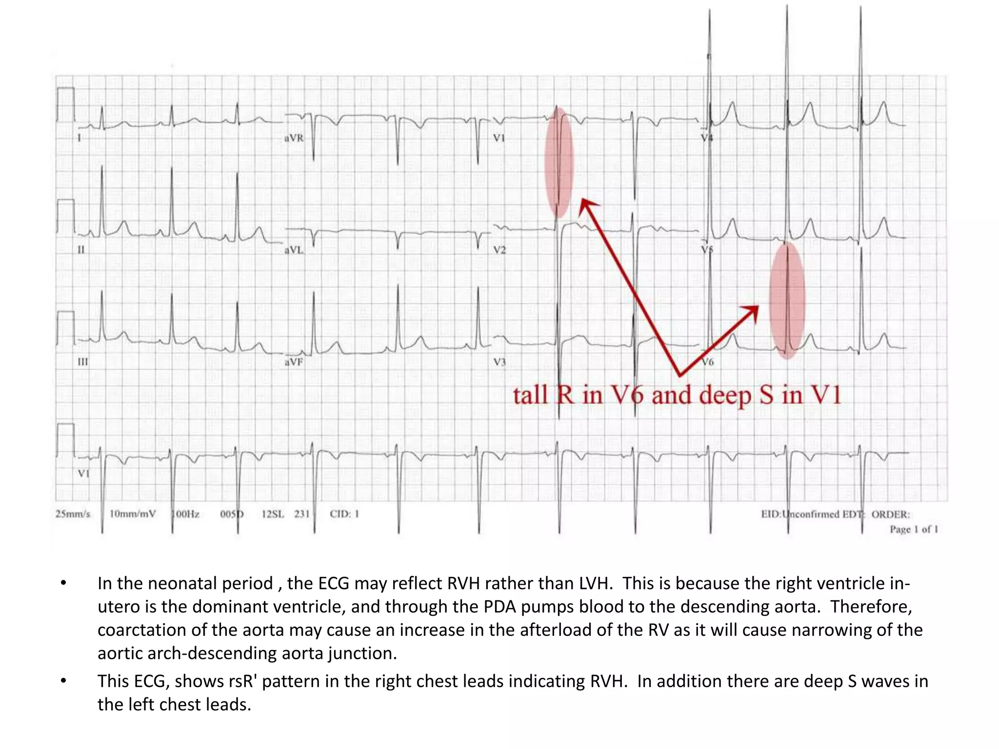 Coarctation of aorta | PPTX
