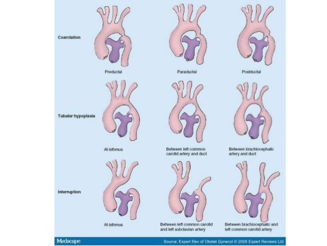 Coarctation of aorta