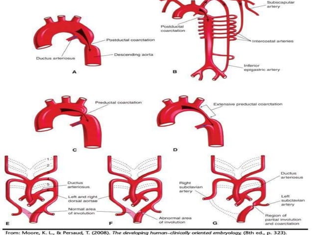 Coarctation of aorta. | PPT