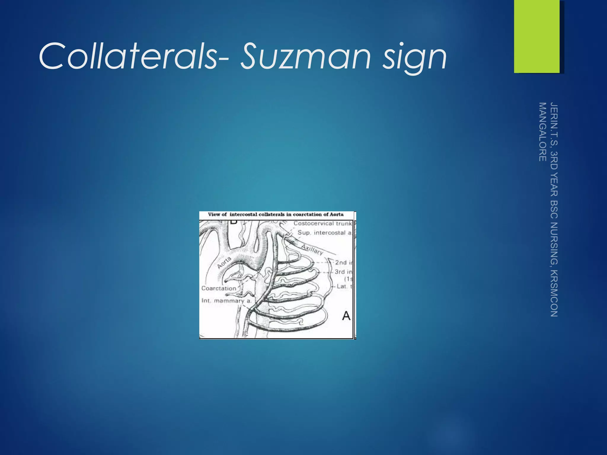 Coarctation of aorta | PPT