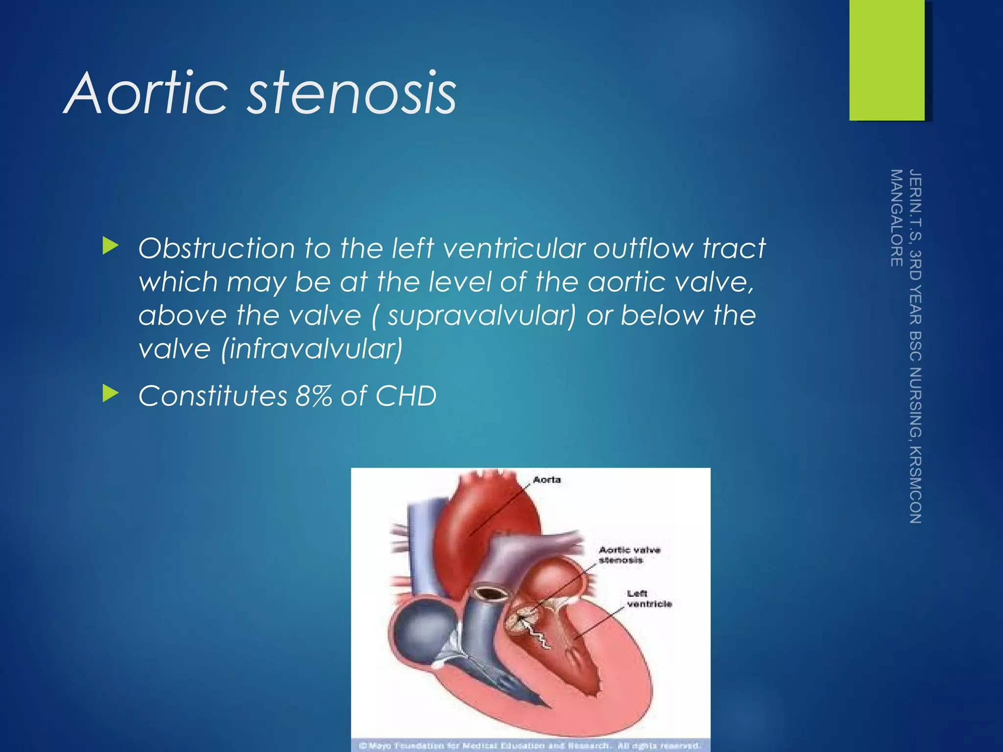 Coarctation of aorta | PPT
