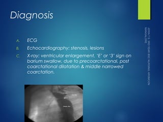 Coarctation of aorta | PPT