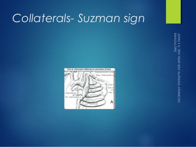 Coarctation of aorta
