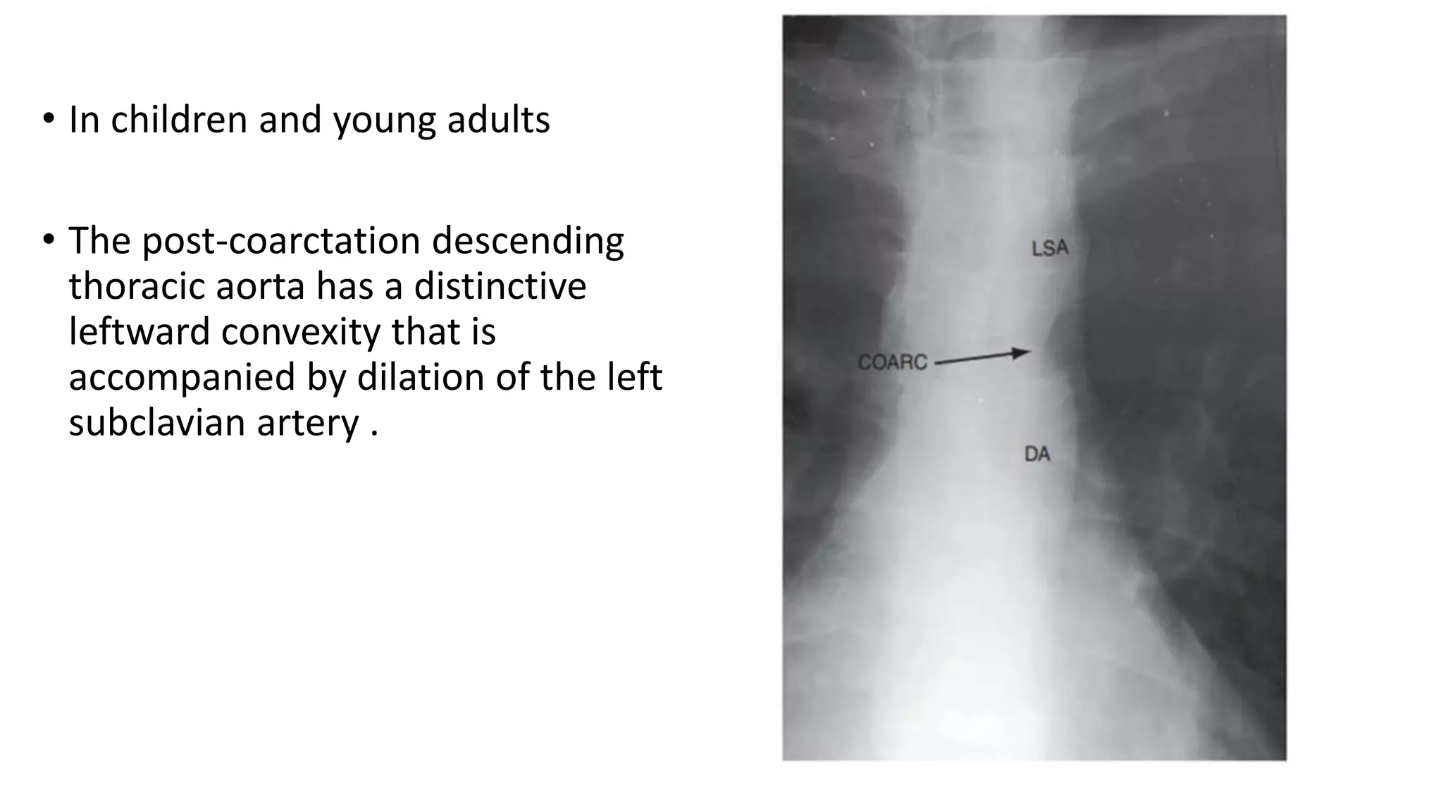 Investigations for Coarctation of aorta | PPTX