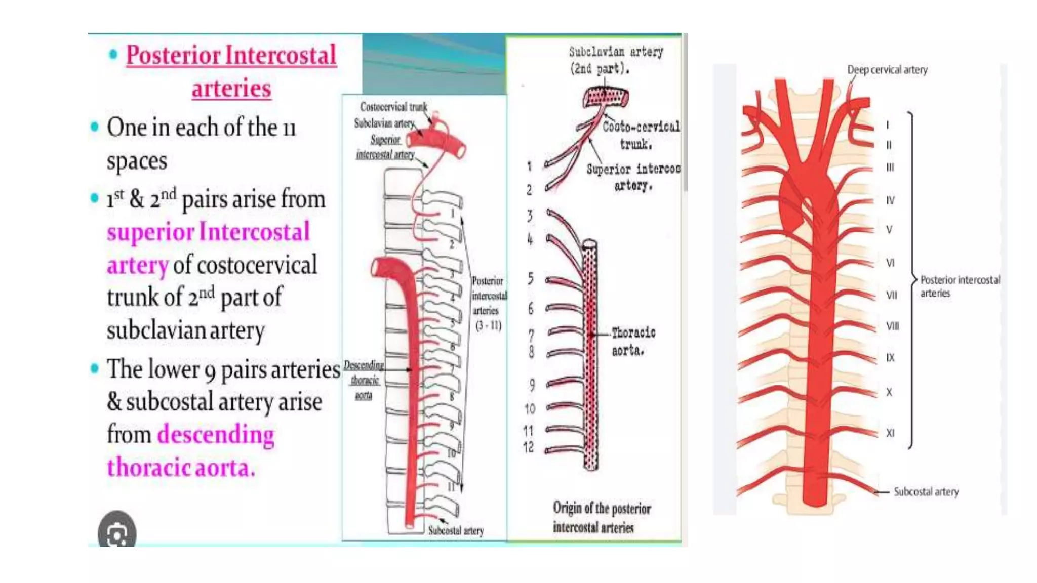 Coarctation of aorta.pptx