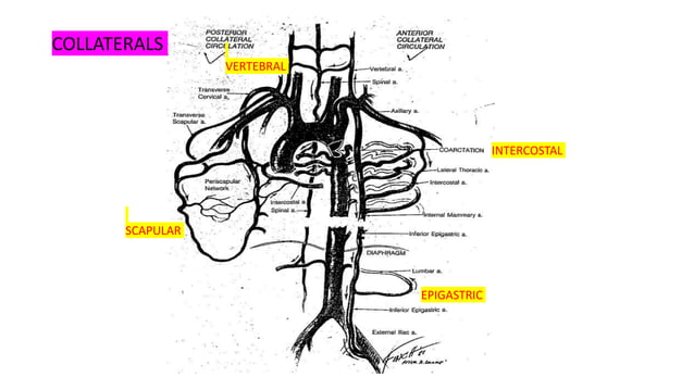 Coarctation Of Aortapptx