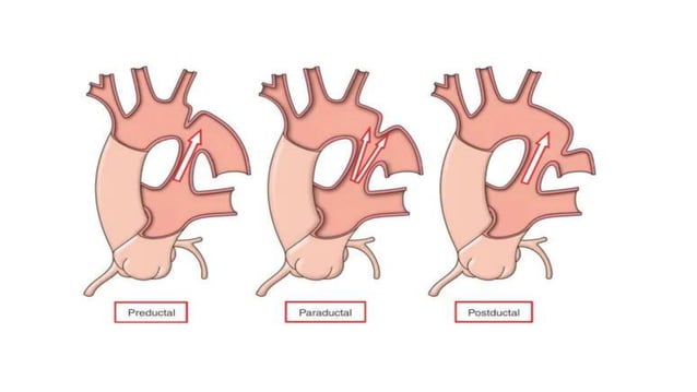 Coarctation of aorta.pptx