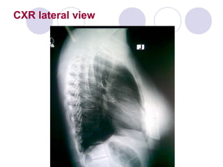 Coarctation of Aorta - A case report | PPT
