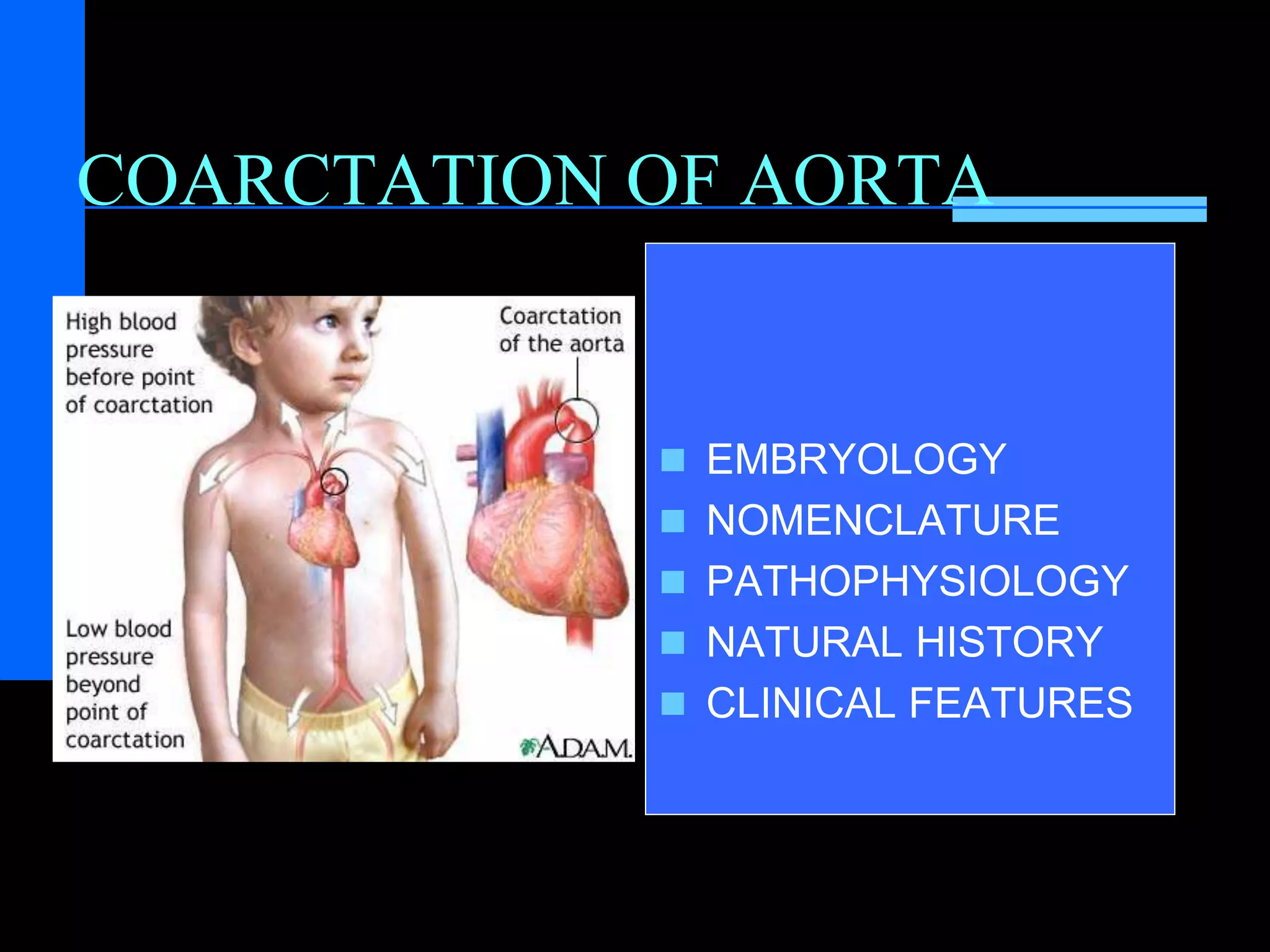 Coarctation of aorta | PPTX
